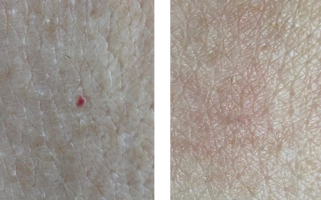 Advanced Electrolysis to treat skin blemishes improve the appearance of ...